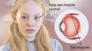 Strabismus - Misaligned Eyes Services - Cataract & Laser Institute ...
